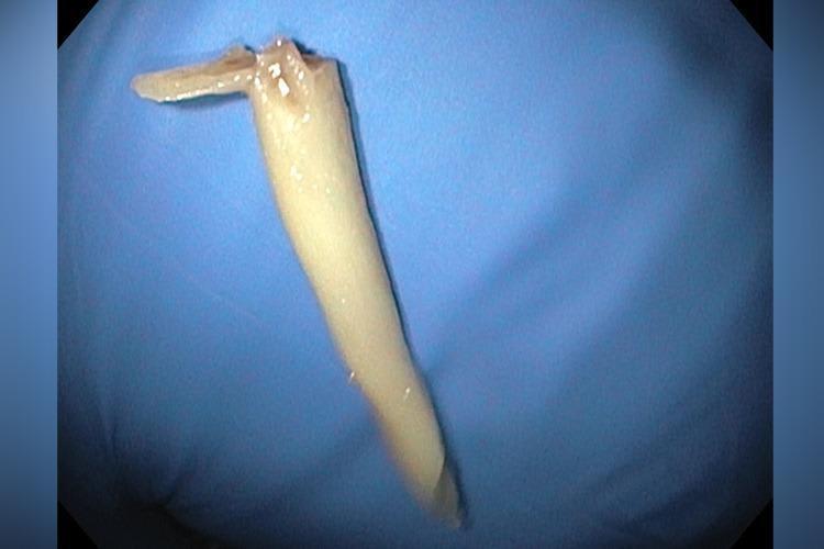 Chicken bone gets stuck in boy's throat for 2 days, hole formed in food ...