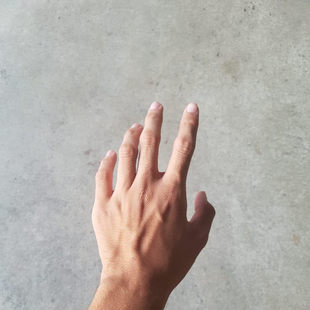 Delhi man bites off subordinate's finger after fight, doctors reattach ...