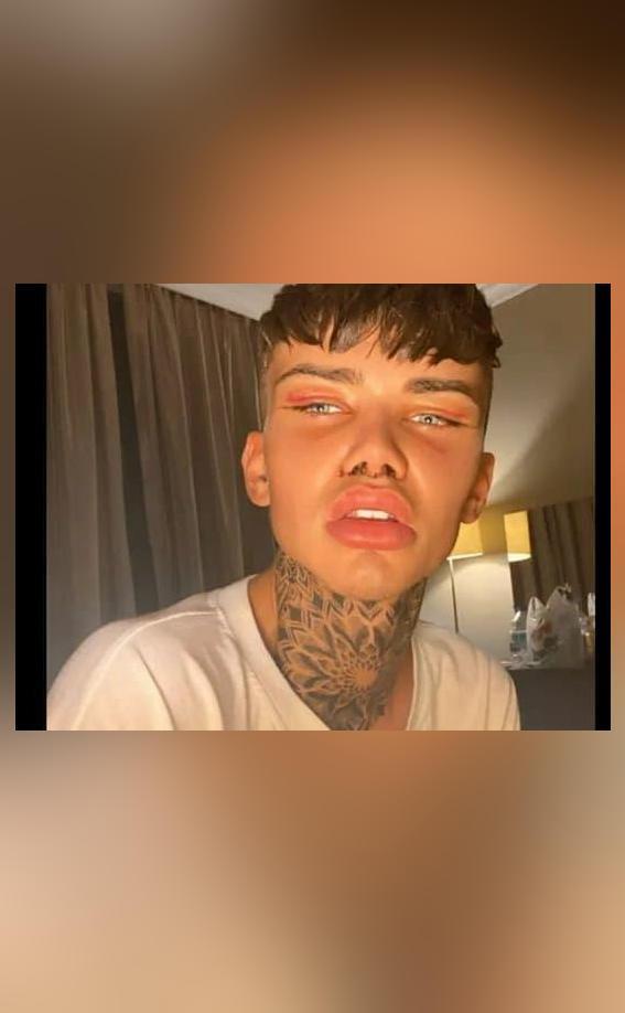 Man spends ₹30 lakh on plastic surgery to look like Instagram filter