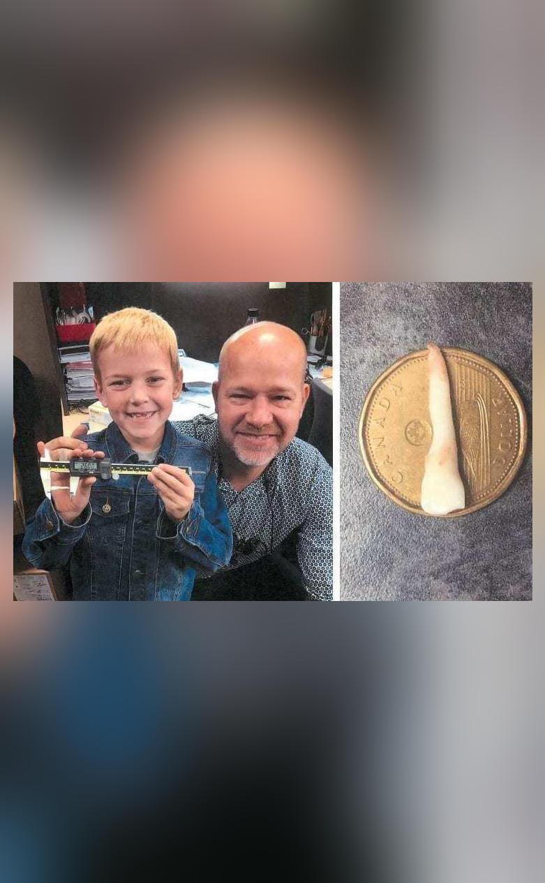 10-yr-old from Canada sets record for longest milk tooth extracted, pic ...