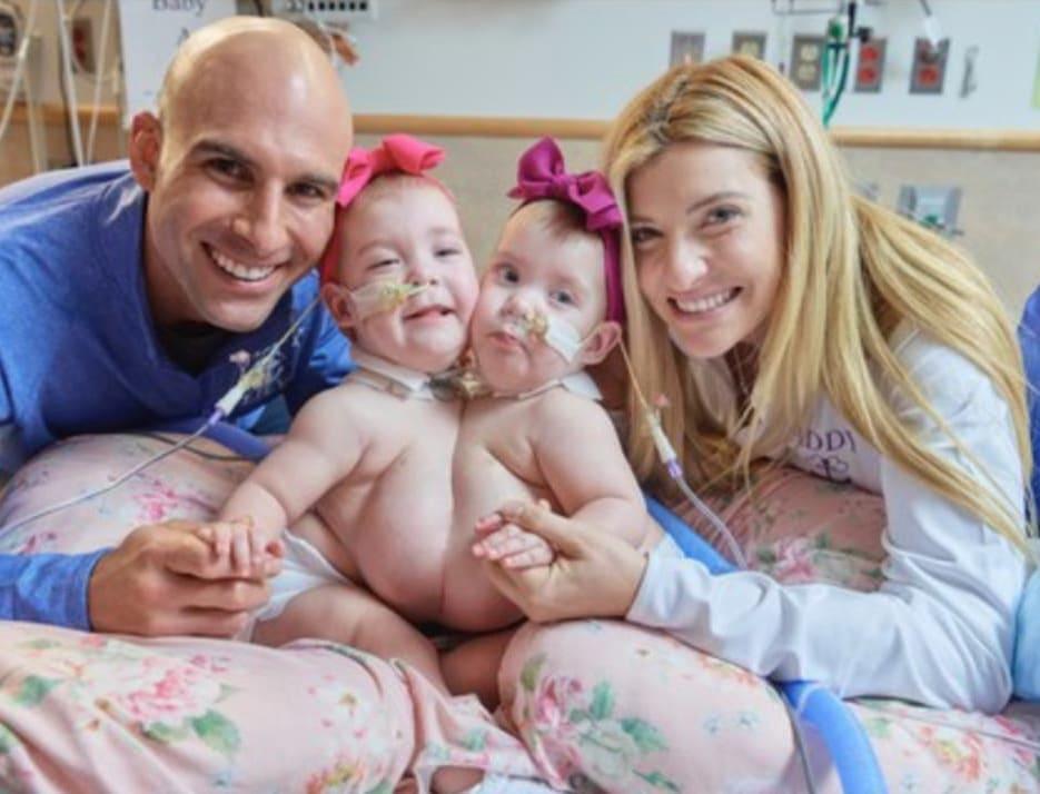 10-month-old conjoined twins joined at abdomen, chest separated in US ...
