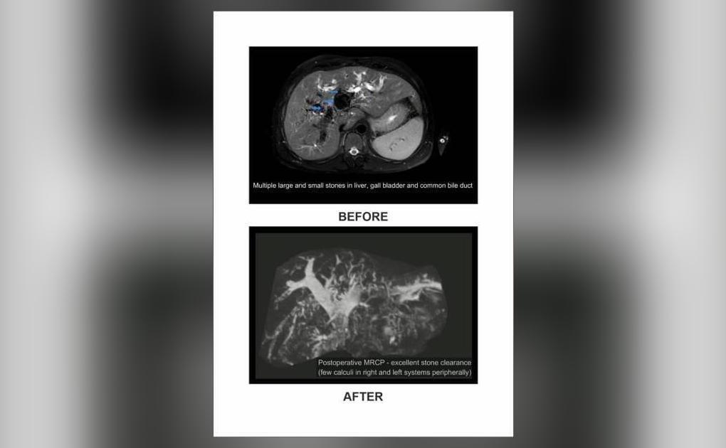 1000 Stones Removed From Mans Liver Gallbladder And Bile Duct In Hyderabad Pics Out