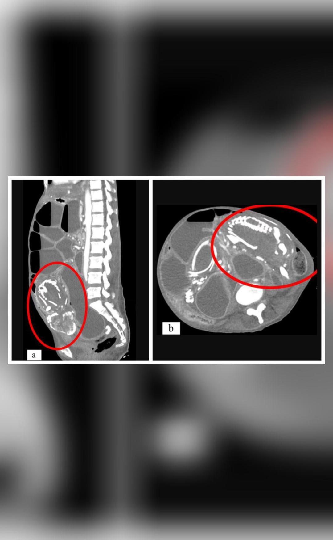 Woman carries rare 'stone baby' in her body for nine years, dies in US