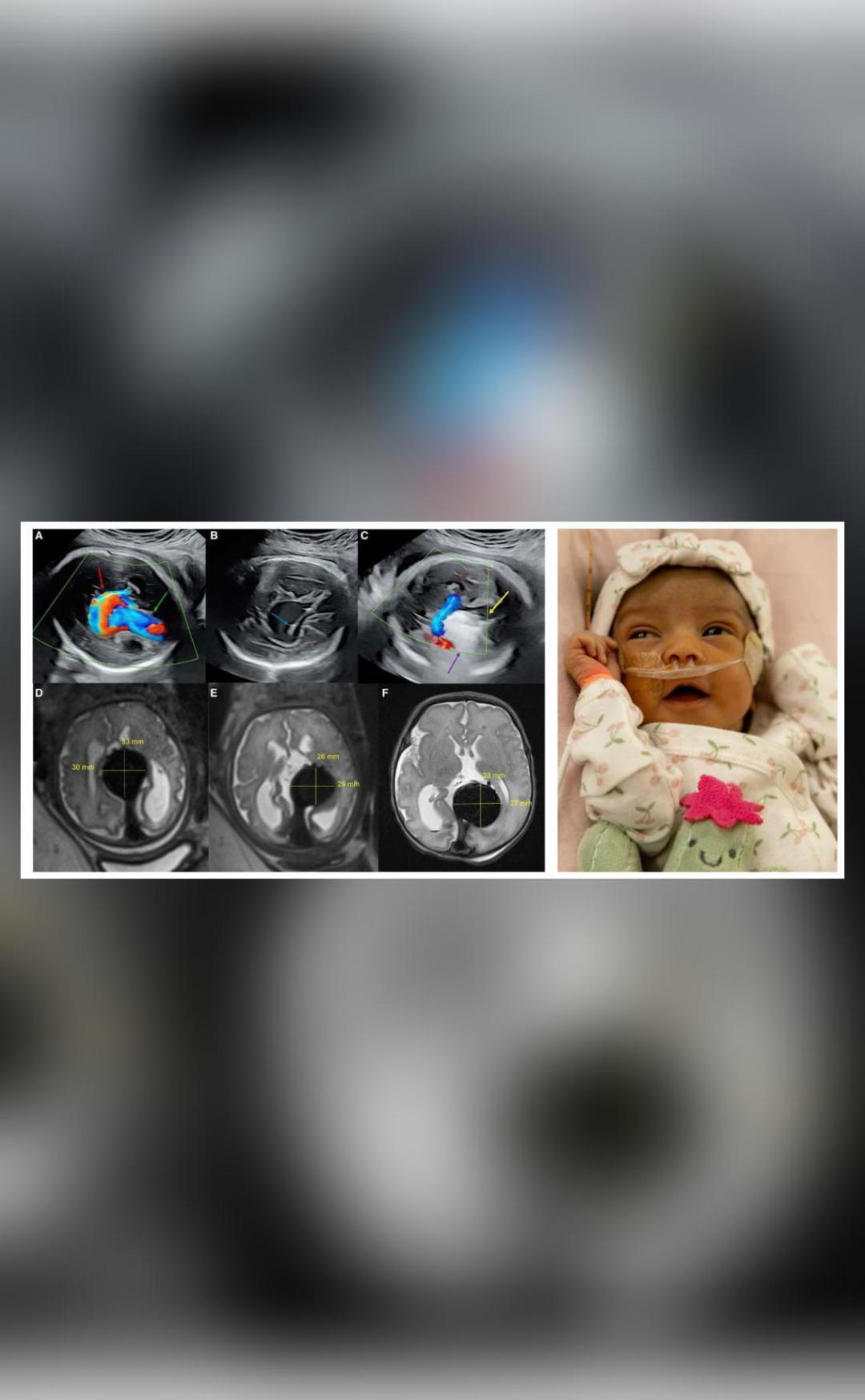 Brain surgery performed on baby still in womb in US; pics released