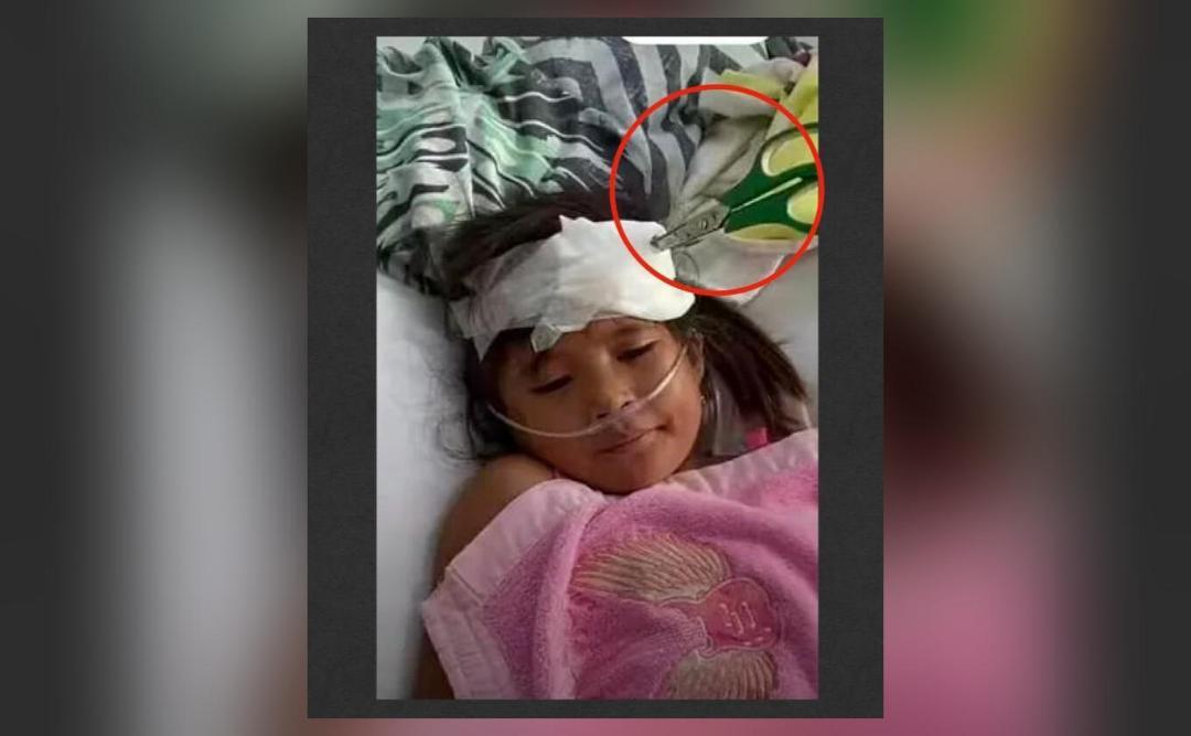 Scissors stuck in girl's skull for over a week in Philippines; pic surfaces