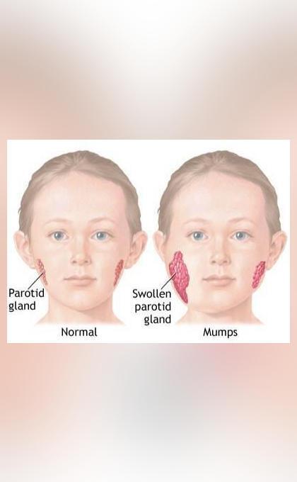 What is mumps and its symptoms as cases rise in India? | EXPLAINERS ...