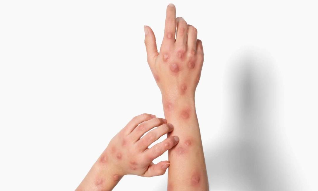 What are the myths about Mpox transmission? | Health___Fitness News ...