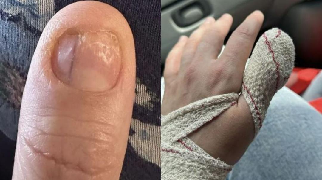 Woman gets diagnosed with skin cancer after wearing acrylic nails ...