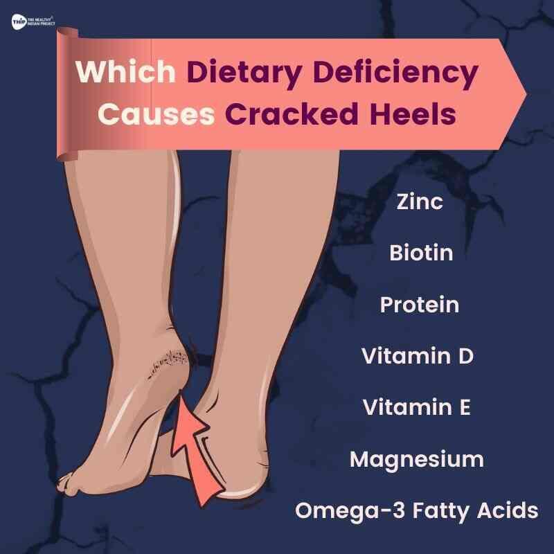 What dietary deficiencies could be causing your cracked feet? | Health ...