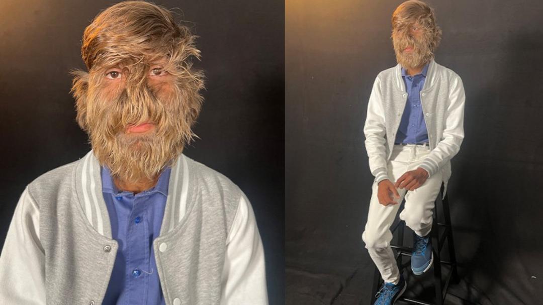 What is Werewolf Syndrome? Rare disorder with abnormal hair growth ...