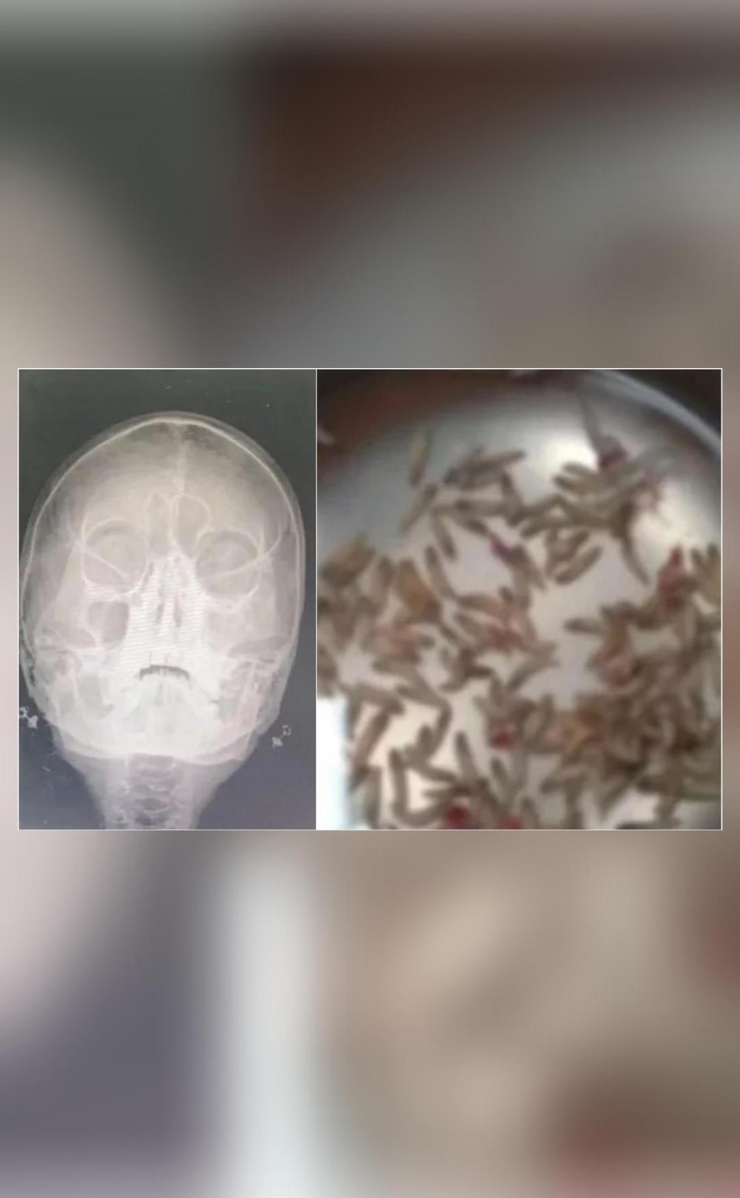 Woman with blocked nose finds over 100 maggots living in nostrils in ...
